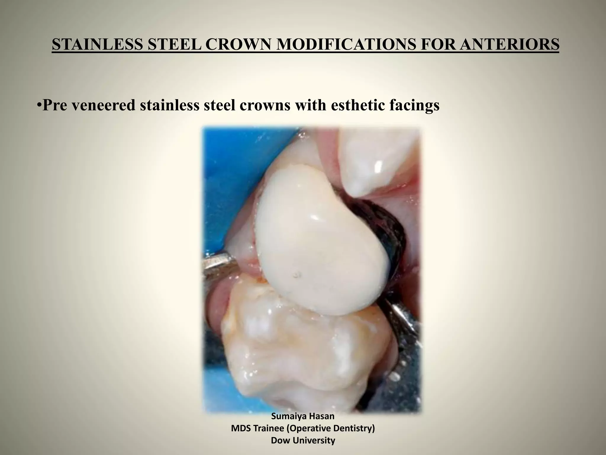 Stainless Steel Crowns In Paediatric Dentistry | PPTX