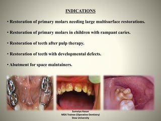 Stainless Steel Crowns In Paediatric Dentistry | PPTX