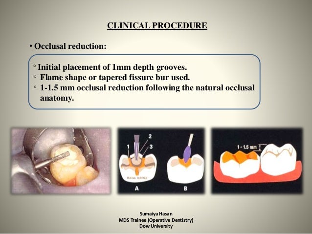 Stainless Steel Crowns In Paediatric Dentistry