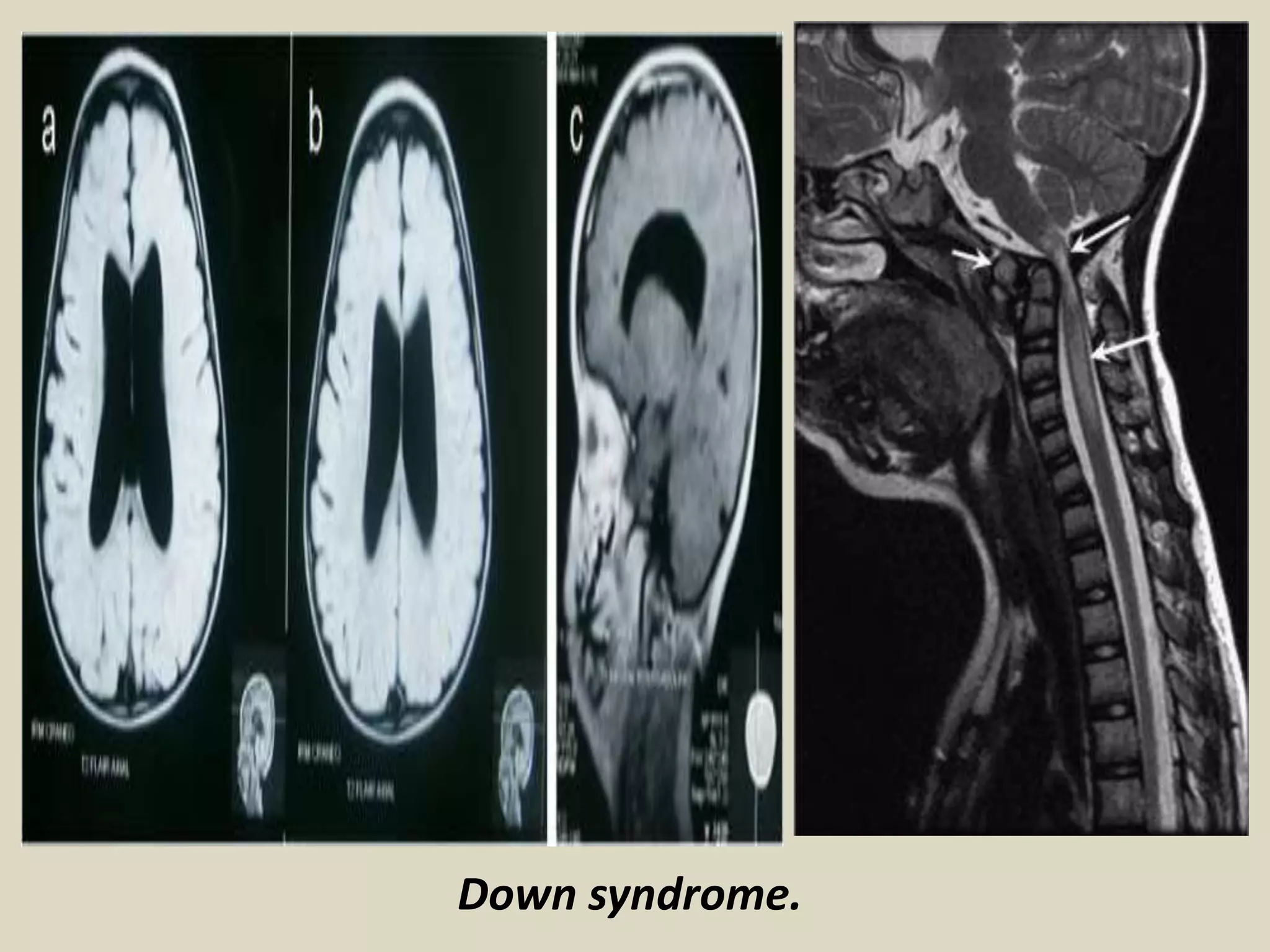 Presentation1.pptx, imaging of genetic diseases. (3) | PPTX