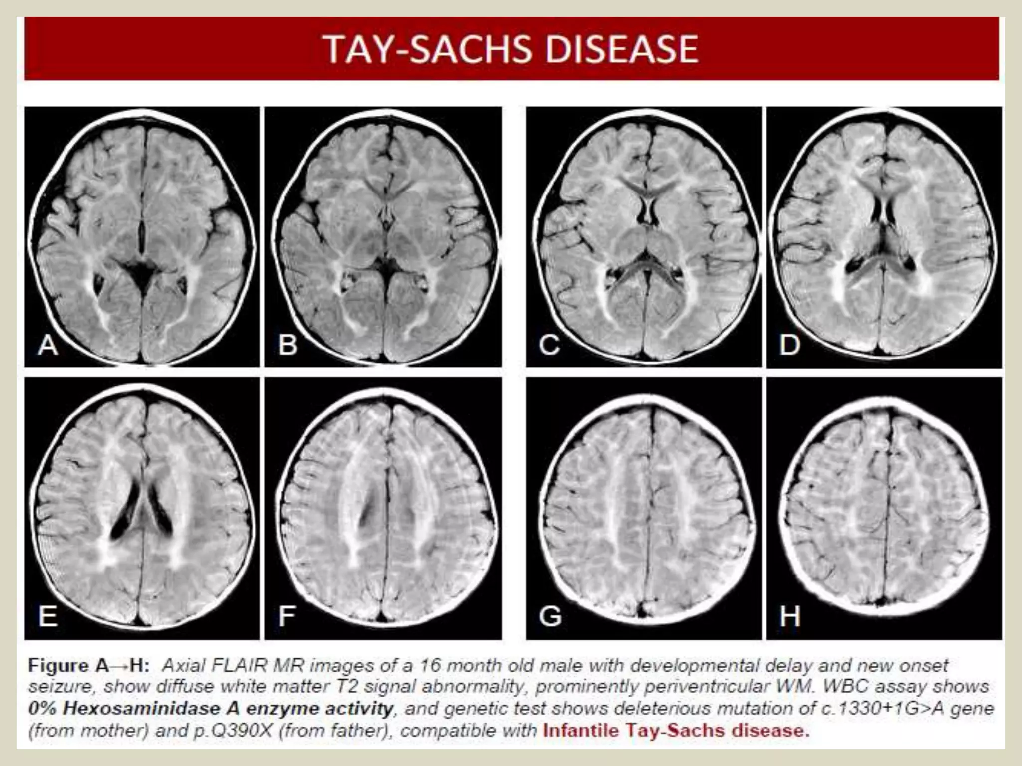 Presentation1.pptx, imaging of genetic diseases. (3) | PPTX