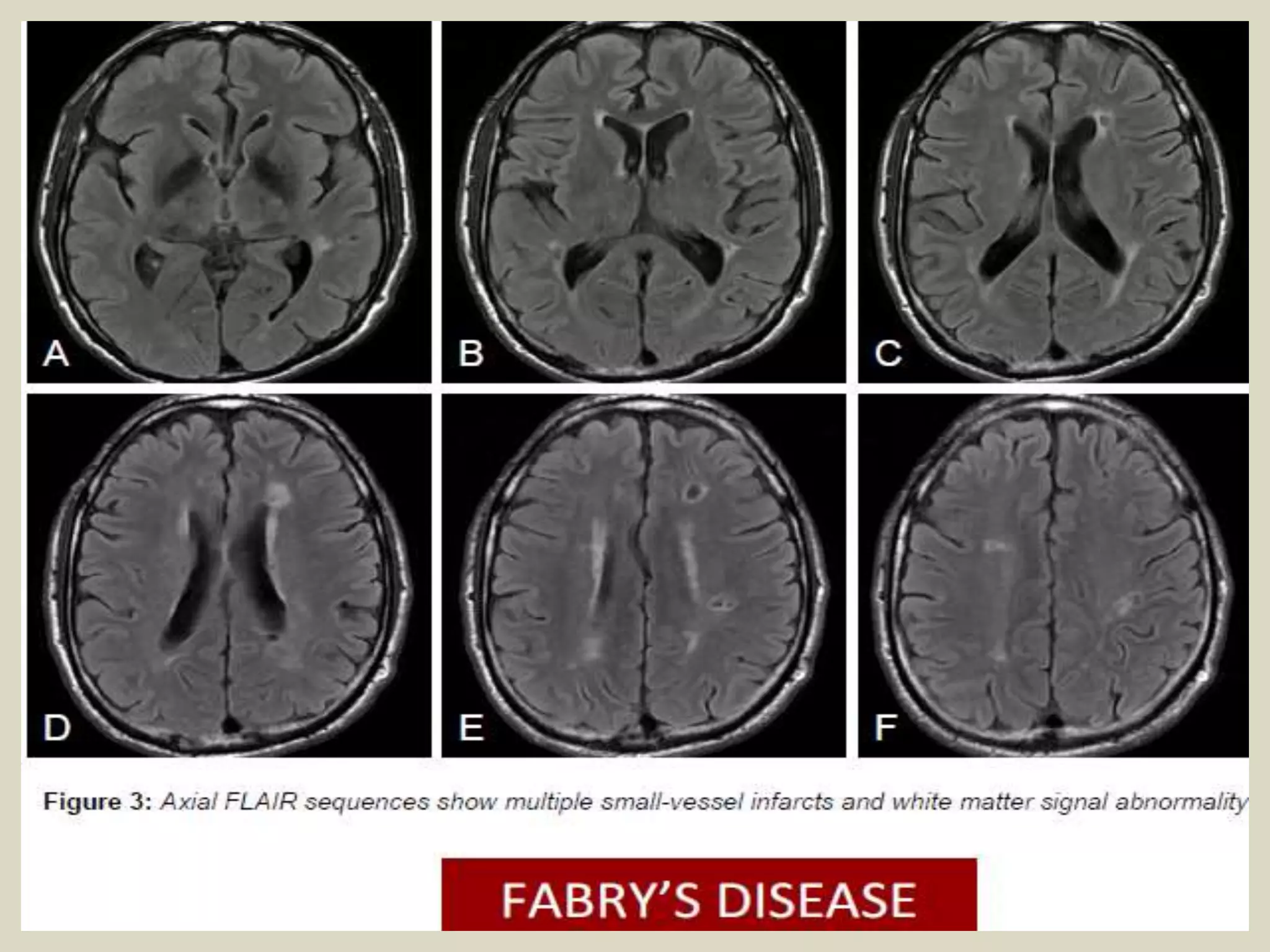 Presentation1.pptx, imaging of genetic diseases. (3) | PPTX