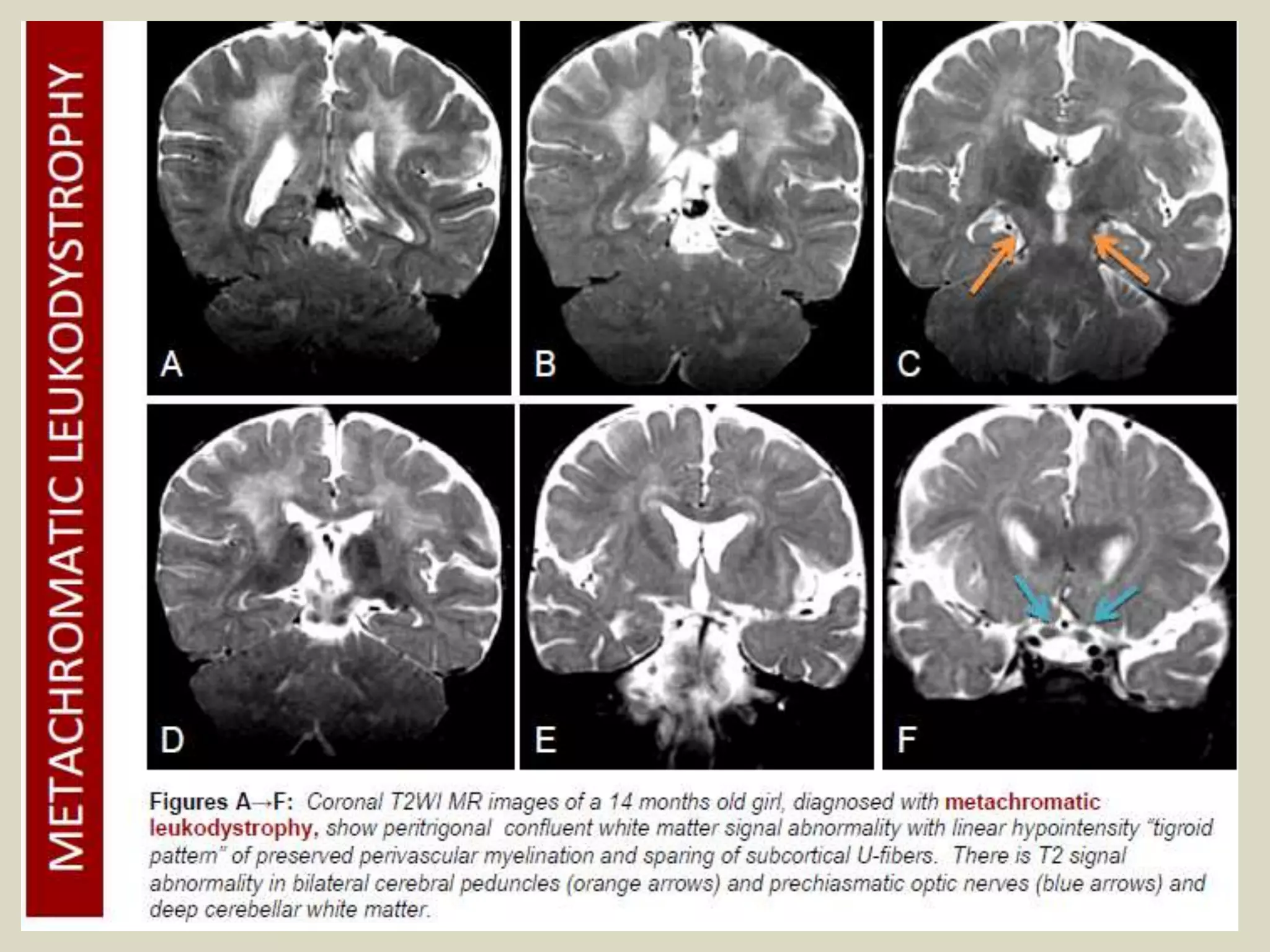 Presentation1.pptx, imaging of genetic diseases. (3) | PPTX