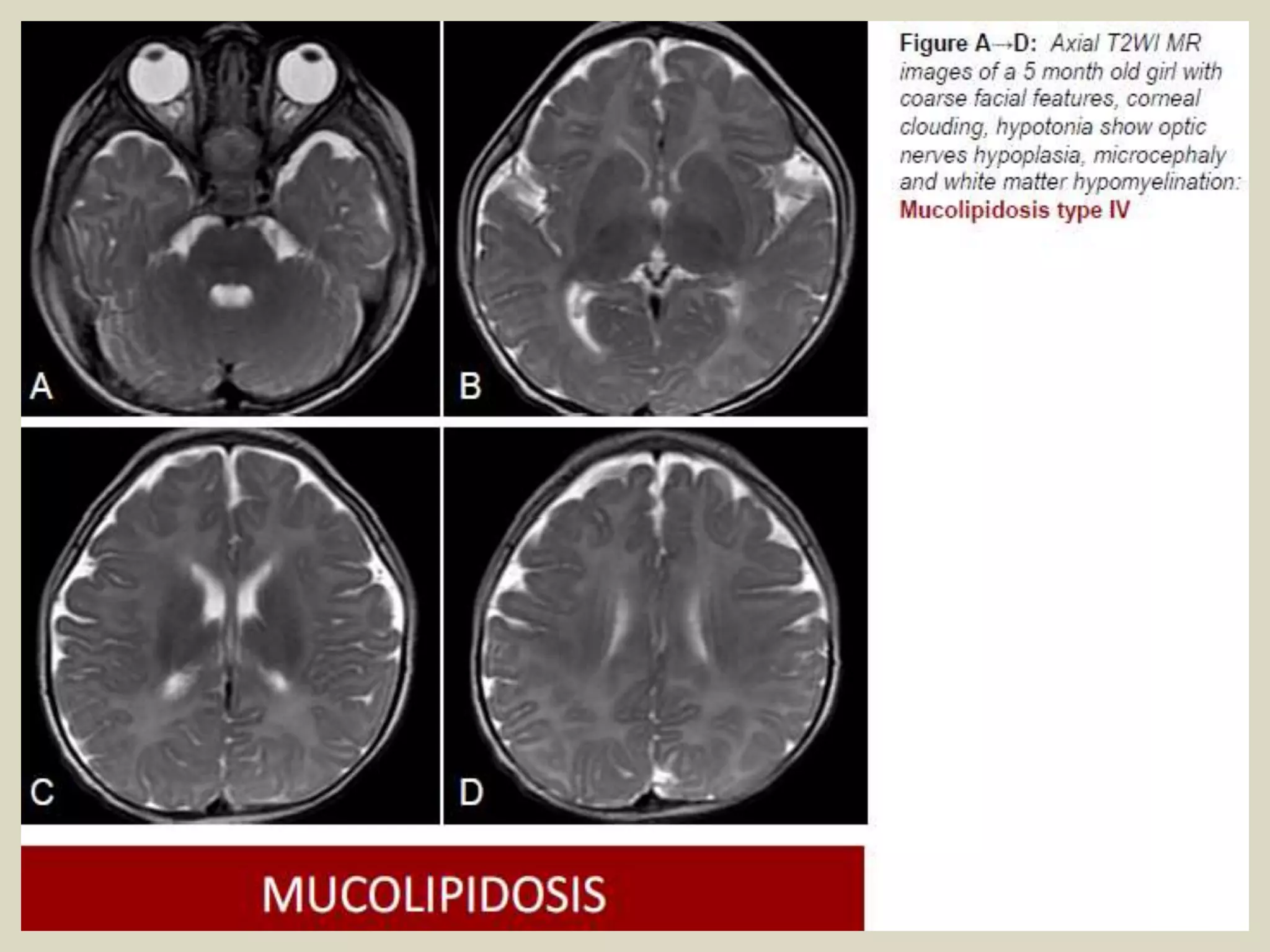 Presentation1.pptx, imaging of genetic diseases. (3) | PPTX