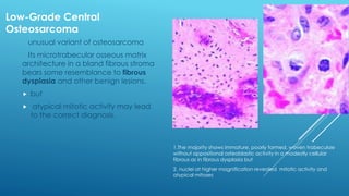 osteosarcoma | PPTX