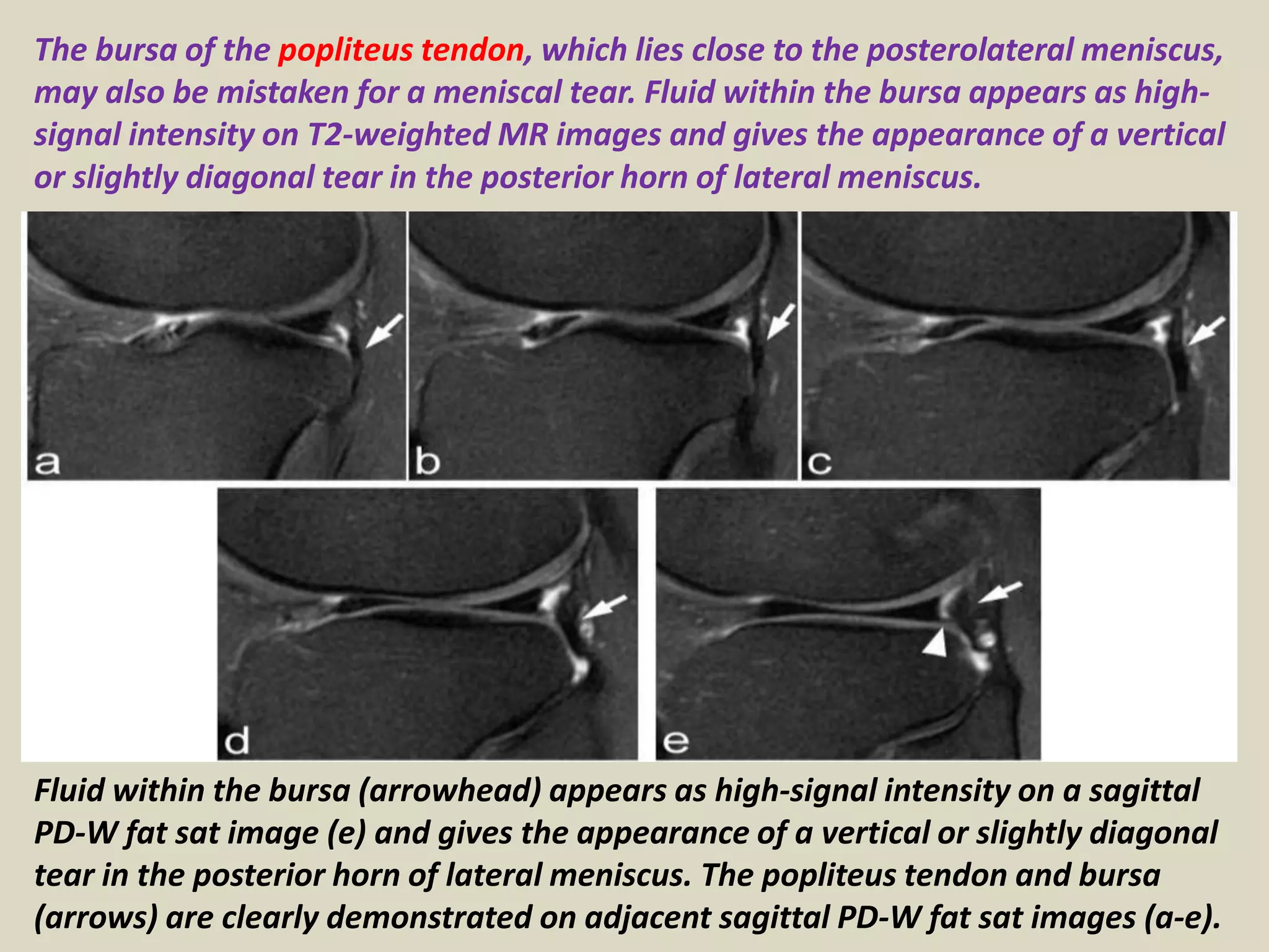 Presentation1.pptx, diagnostic pitfalls mimicking meniscal tear and ...