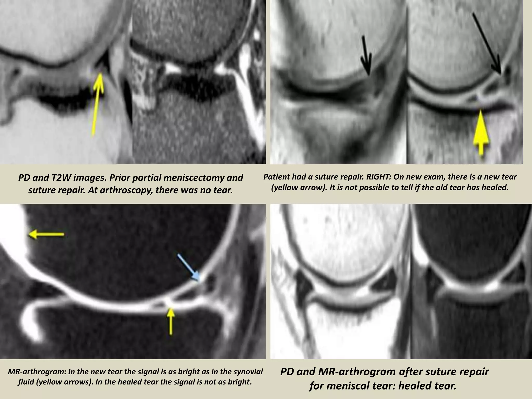 Presentation1.pptx, diagnostic pitfalls mimicking meniscal tear and ...