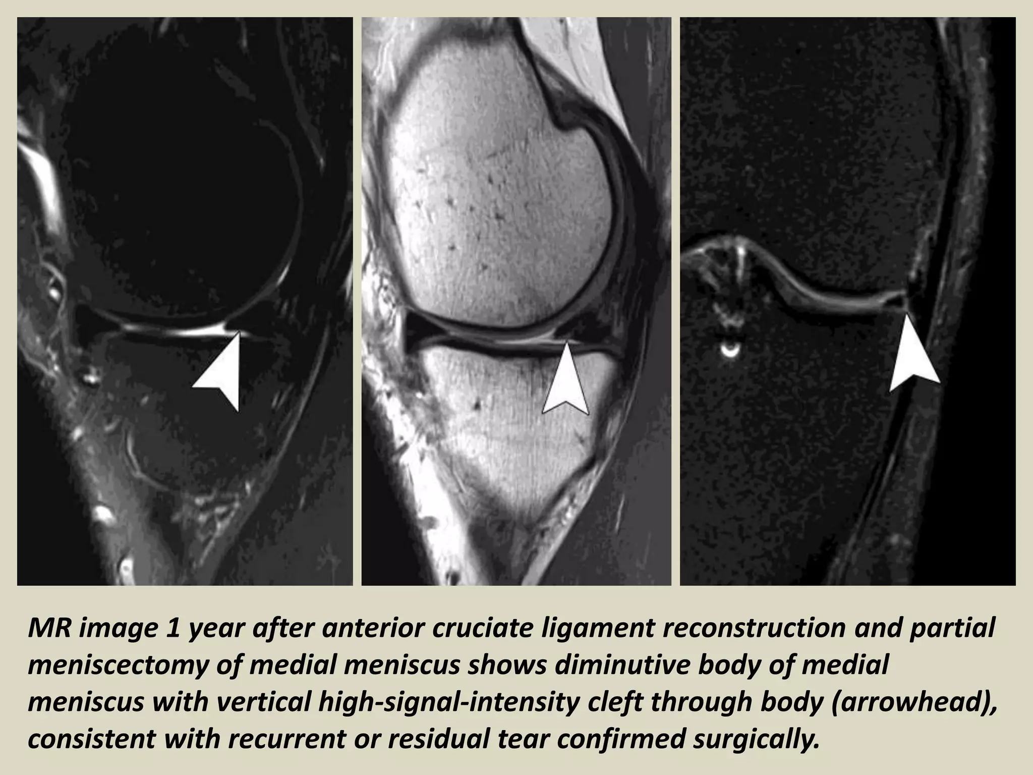 Presentation1.pptx, diagnostic pitfalls mimicking meniscal tear and ...