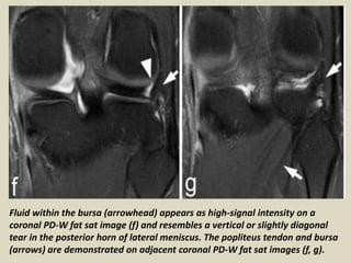 Presentation1.pptx, diagnostic pitfalls mimicking meniscal tear and ...
