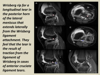 Presentation1.pptx, diagnostic pitfalls mimicking meniscal tear and ...