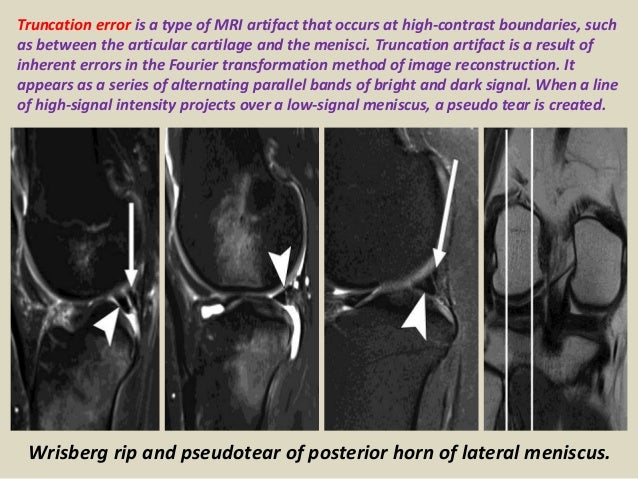 Presentation1.pptx, diagnostic pitfalls mimicking meniscal tear and p…