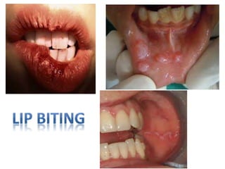 Lip Biting Habit