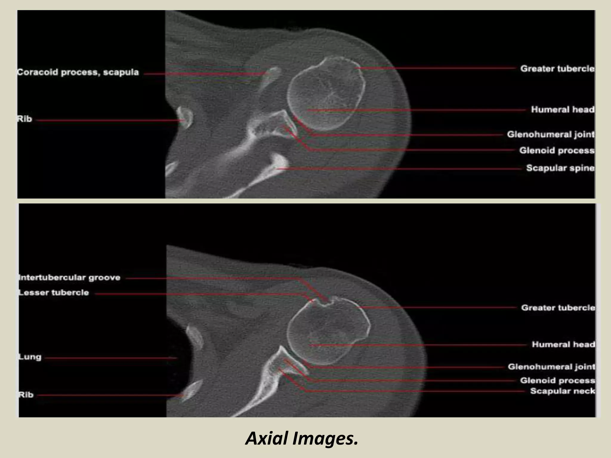 Presentation1.pptx, radiological anatomy of the shoulder joint. | PPTX