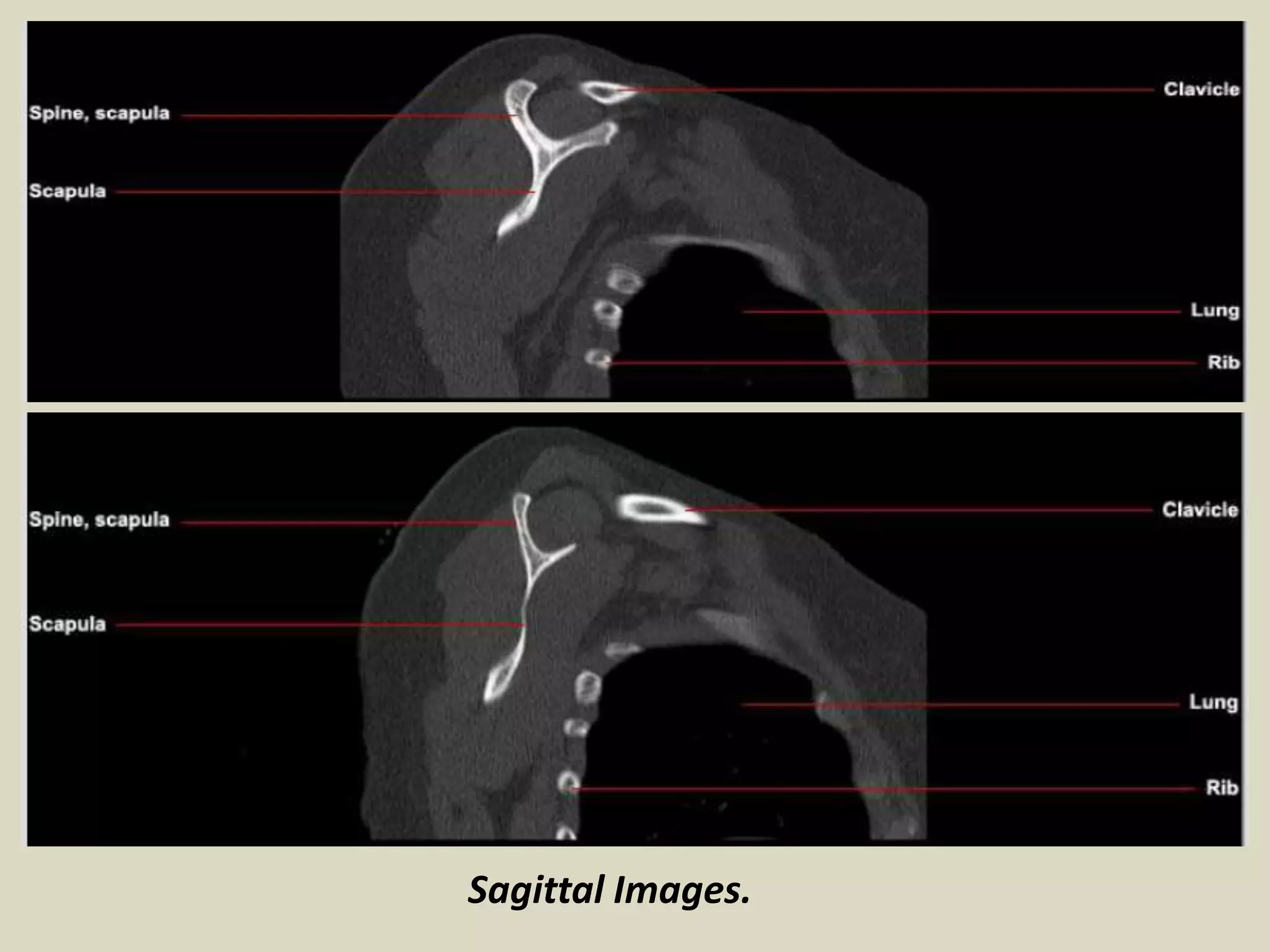 Presentation1.pptx, radiological anatomy of the shoulder joint. | PPTX
