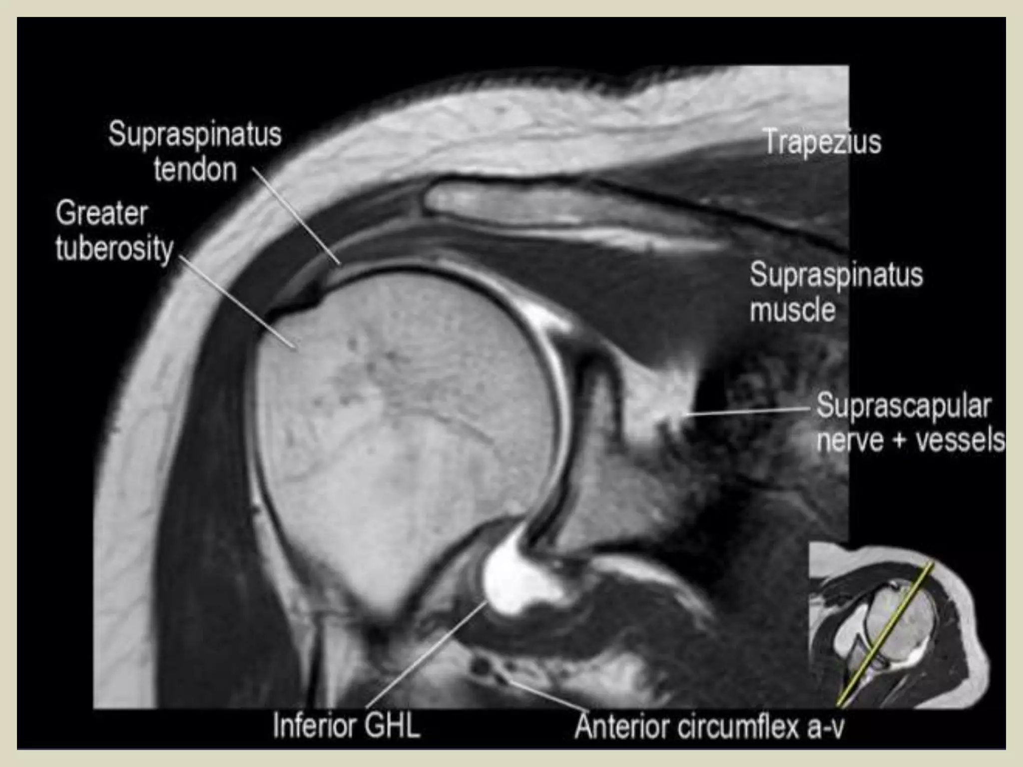 Presentation1.pptx, radiological anatomy of the shoulder joint. | PPTX