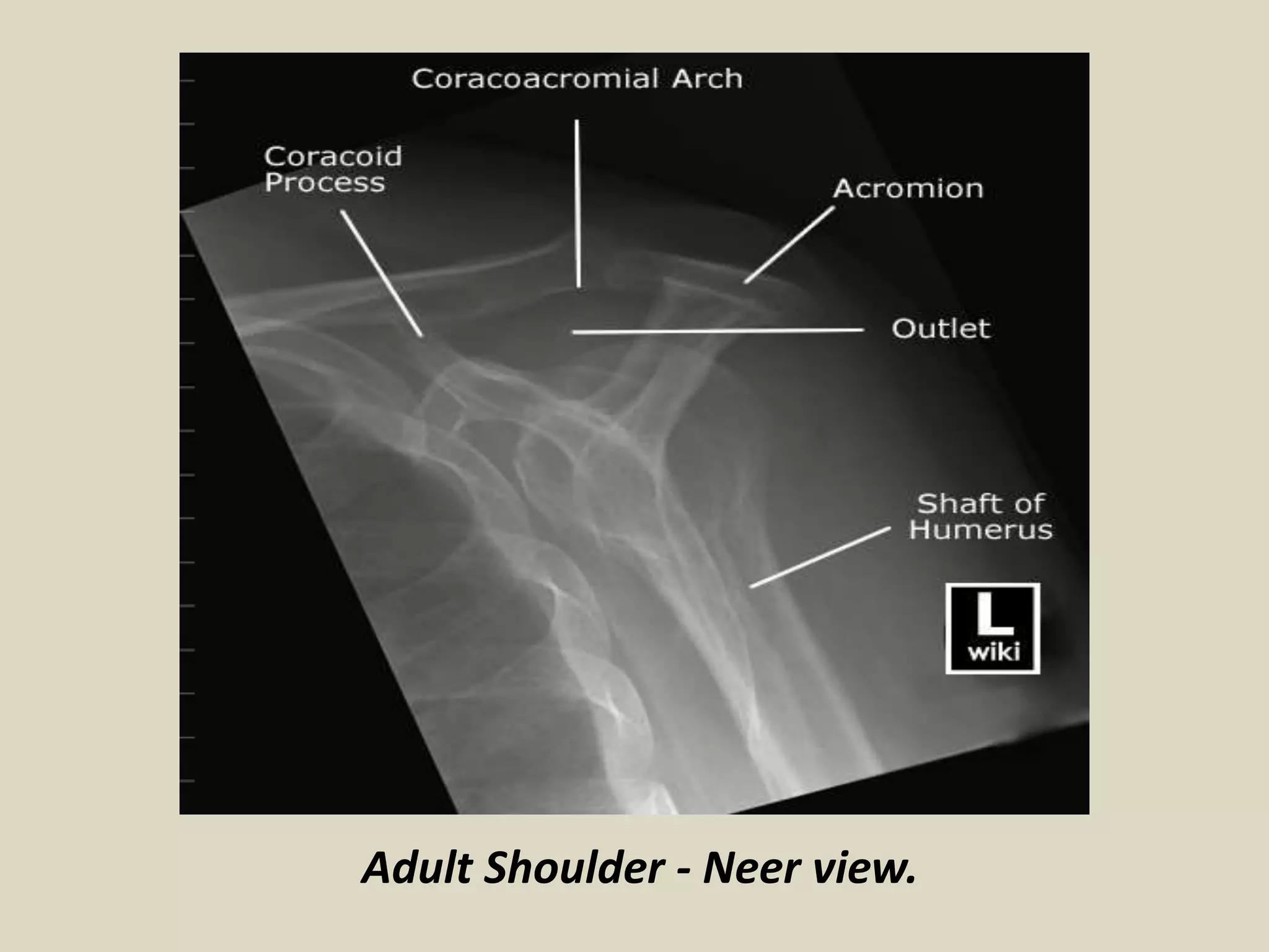Presentation1.pptx, radiological anatomy of the shoulder joint. | PPTX