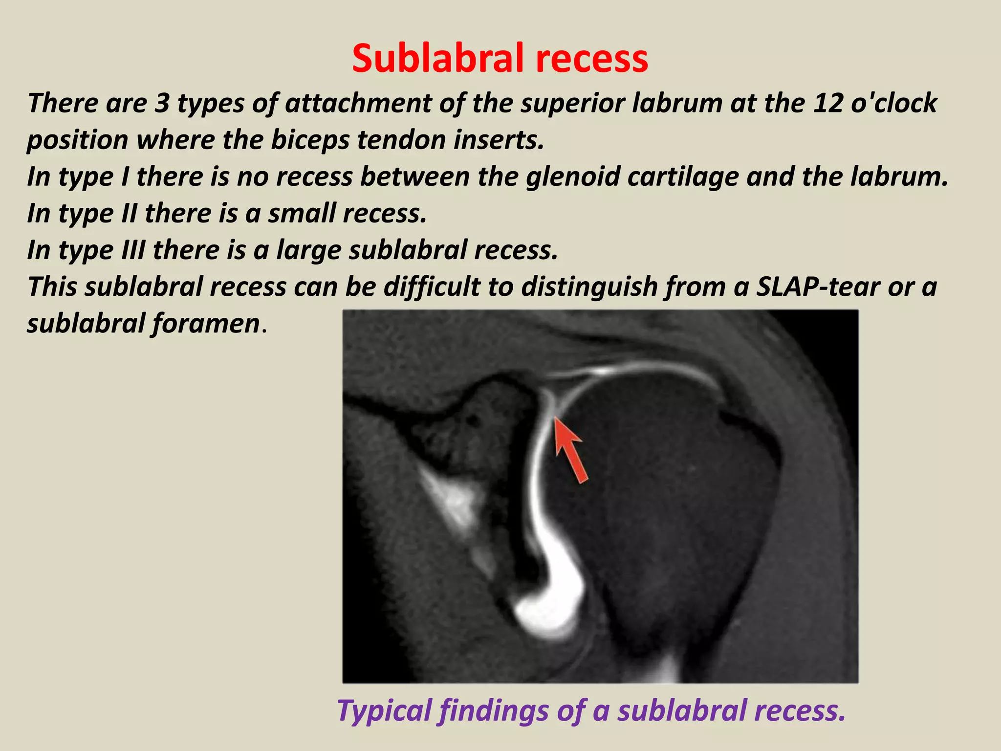 Presentation1.pptx, radiological anatomy of the shoulder joint. | PPTX