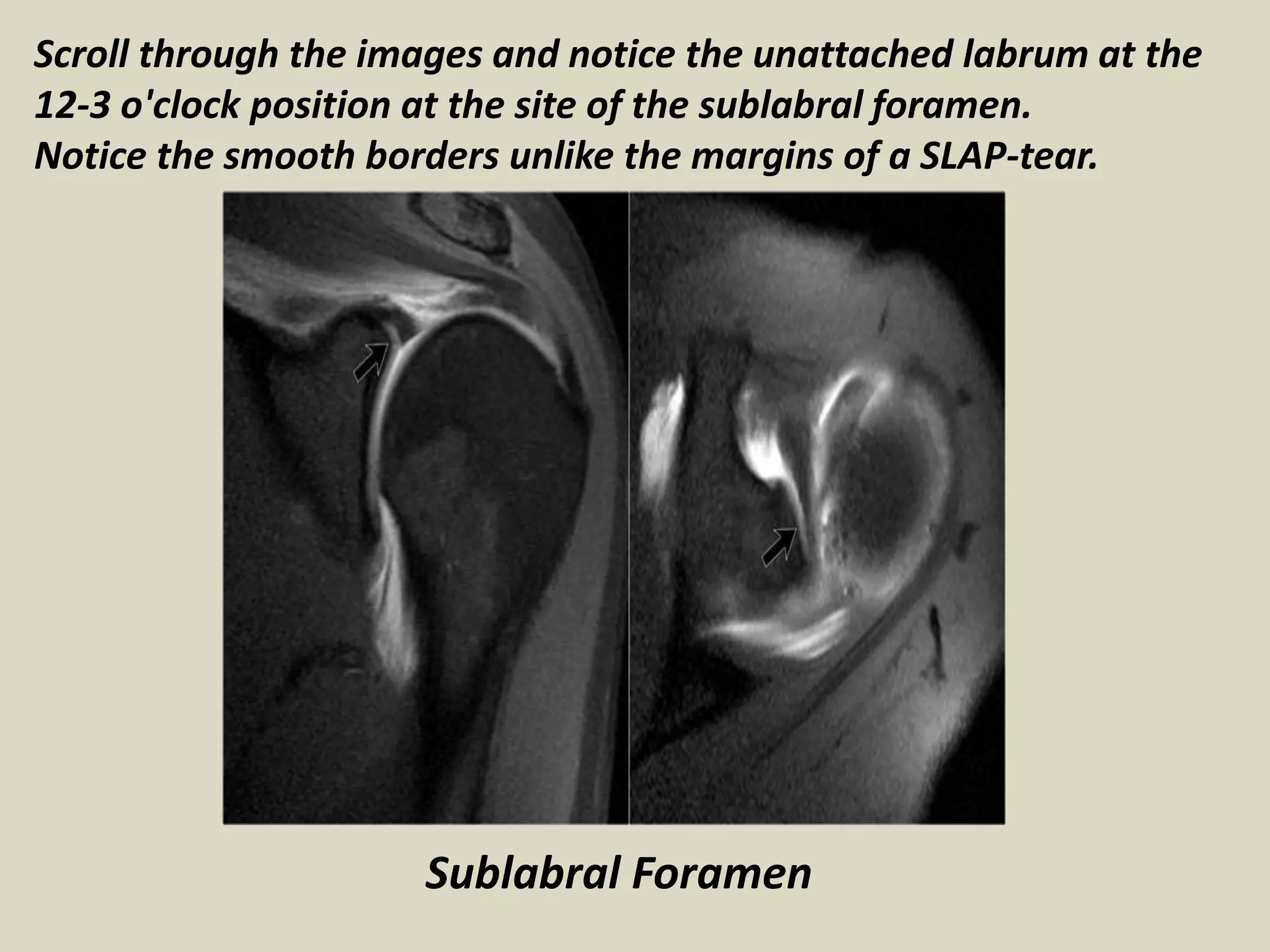 Presentation1.pptx, radiological anatomy of the shoulder joint. | PPTX