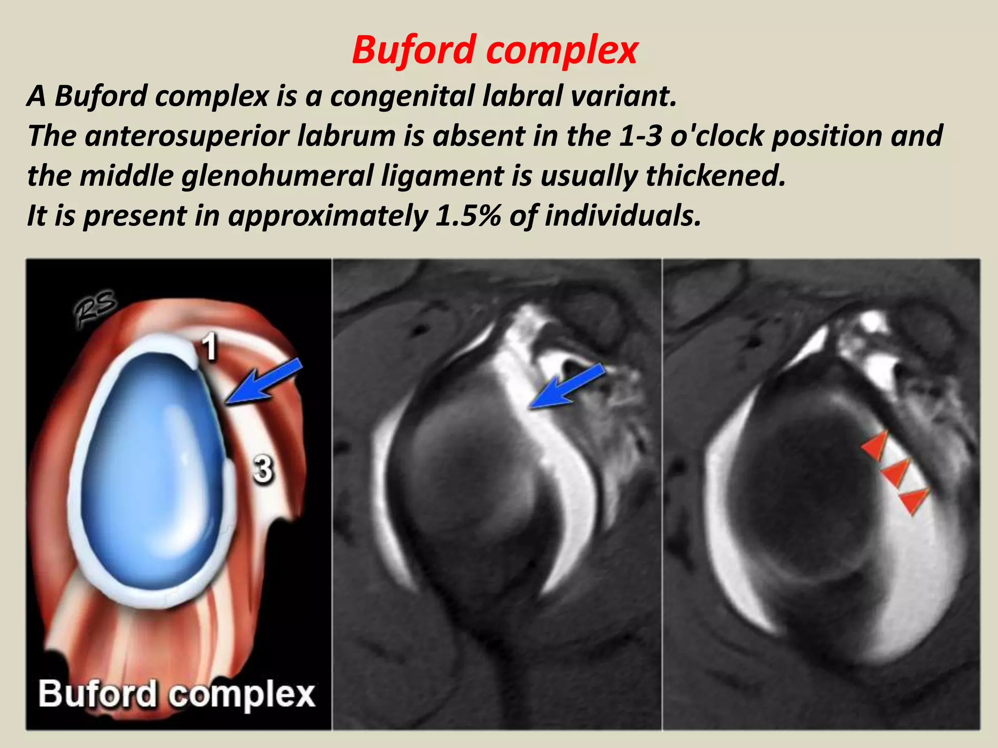 Presentation1.pptx, radiological anatomy of the shoulder joint. | PPTX