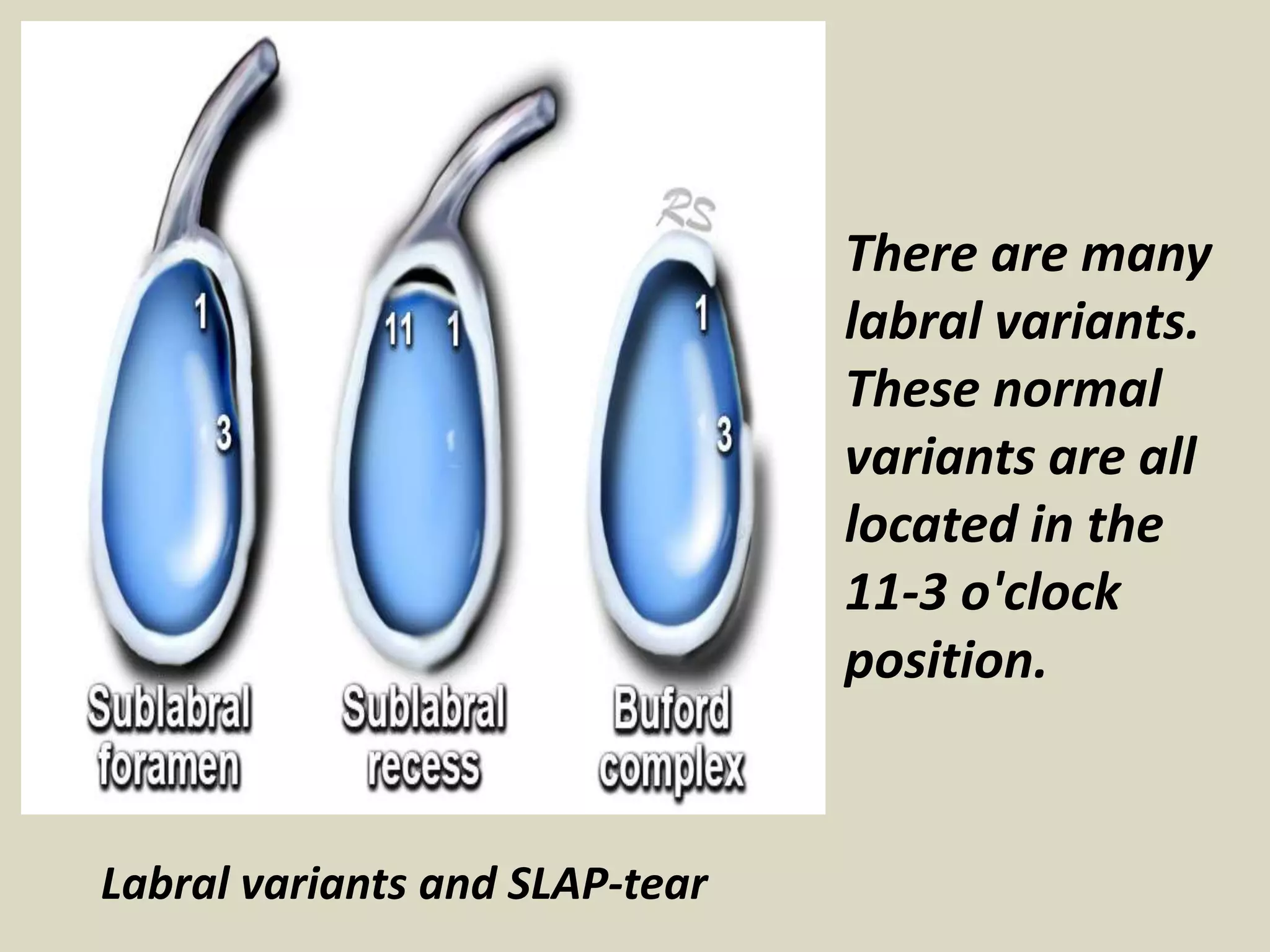 Presentation1.pptx, radiological anatomy of the shoulder joint. | PPTX