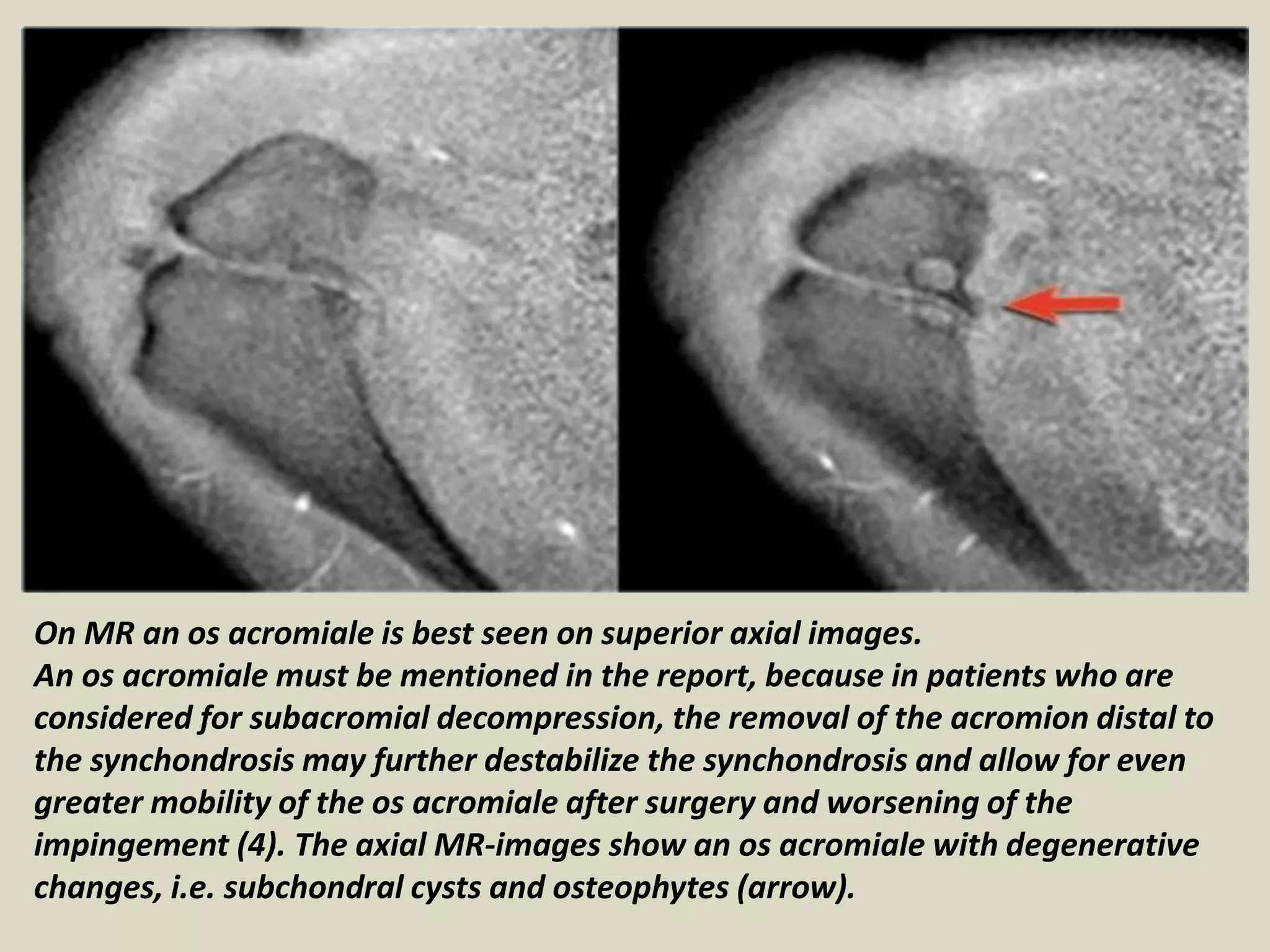 Presentation1.pptx, radiological anatomy of the shoulder joint. | PPTX