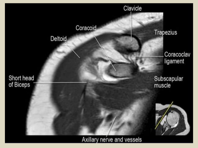 Presentation1.pptx, radiological anatomy of the shoulder joint. | PPTX ...