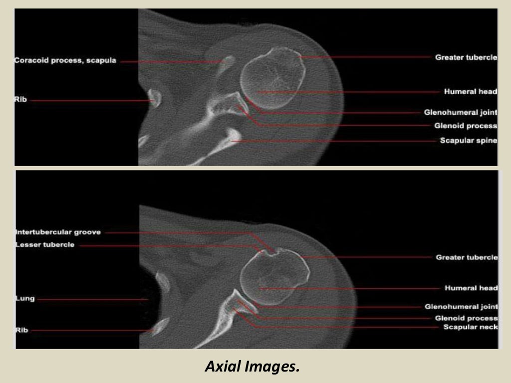Presentation1.pptx, radiological anatomy of the shoulder joint.