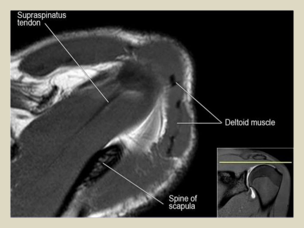Presentation1.pptx, radiological anatomy of the shoulder joint.