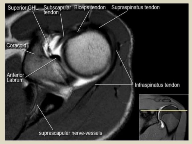 Presentation1.pptx, radiological anatomy of the shoulder joint.