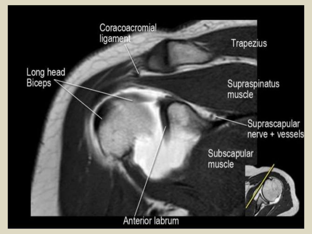 Presentation1.pptx, radiological anatomy of the shoulder joint.