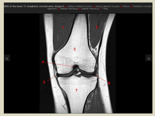 Presentation1.pptx, radiological anatomy of the knee joint. | PPTX ...