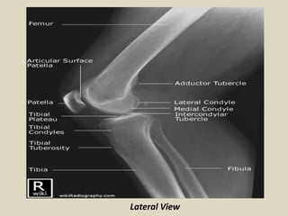 Adductor Tubercle X Ray
