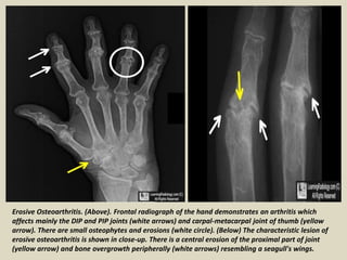 Presentation1.pptx, radiological imaging of osteoarthritis. | PPTX