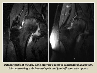 Osteoarthritis Hip Mri