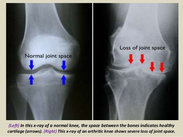Presentation1.pptx, radiological imaging of osteoarthritis.