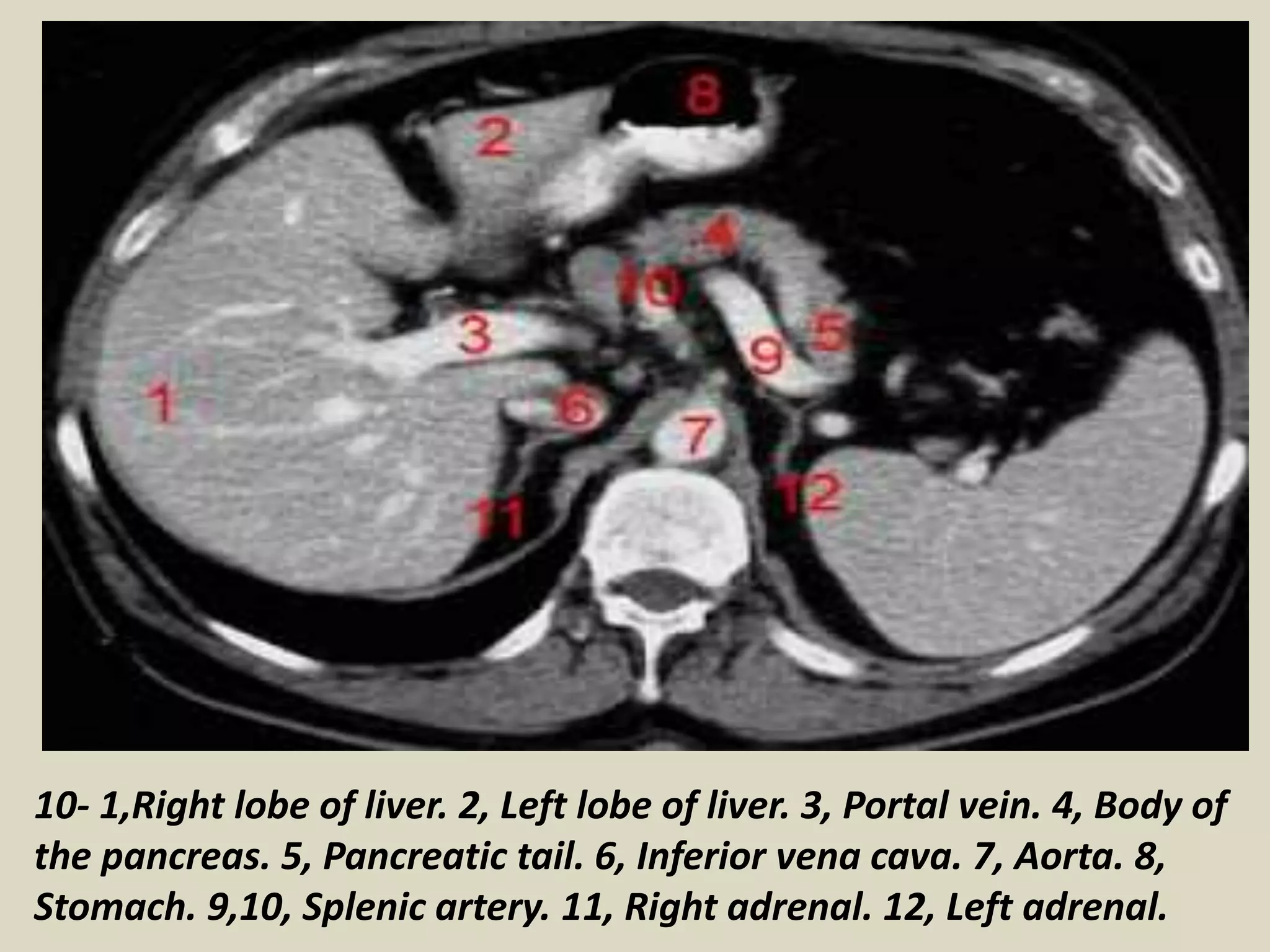 Presentation1.pptx, ct normal anatomy of the abdomen and pelvis. | PPTX