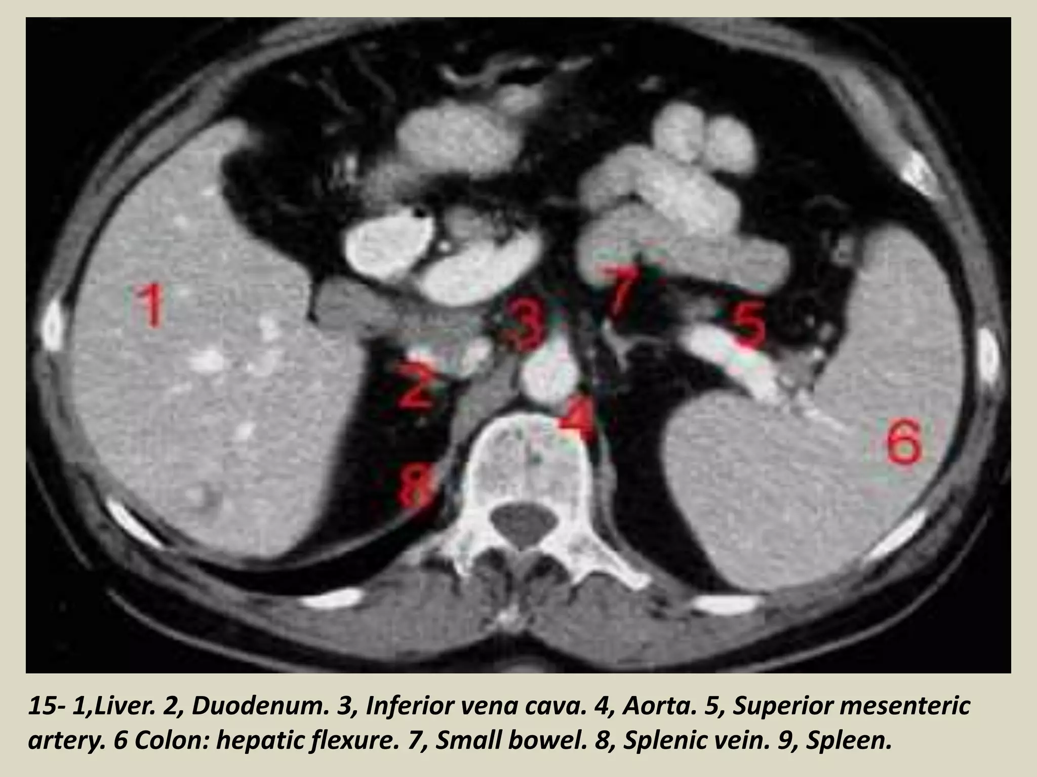 Presentation1.pptx, ct normal anatomy of the abdomen and pelvis. | PPTX