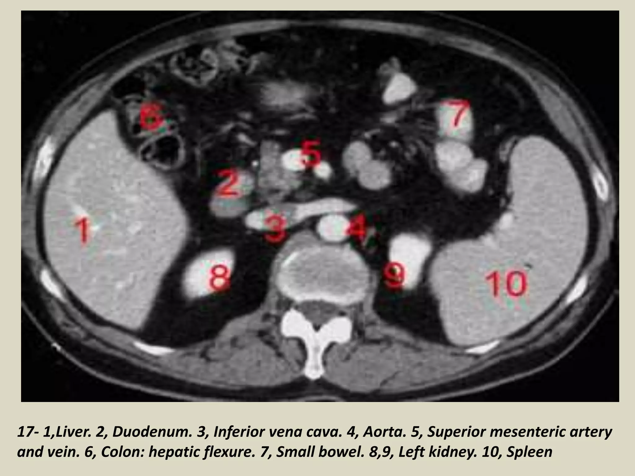 Presentation1.pptx, ct normal anatomy of the abdomen and pelvis. | PPTX