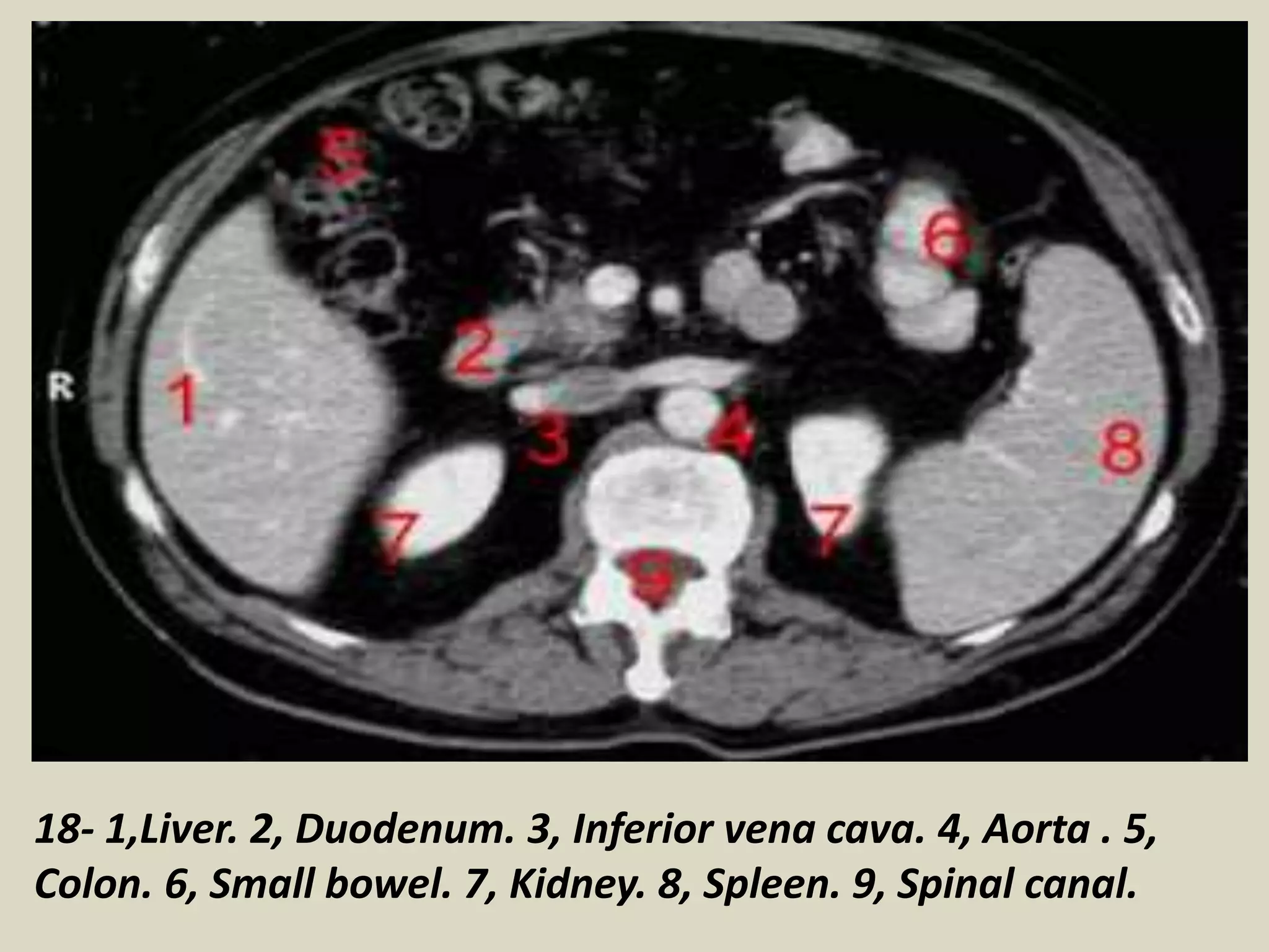 Presentation1.pptx, ct normal anatomy of the abdomen and pelvis. | PPTX