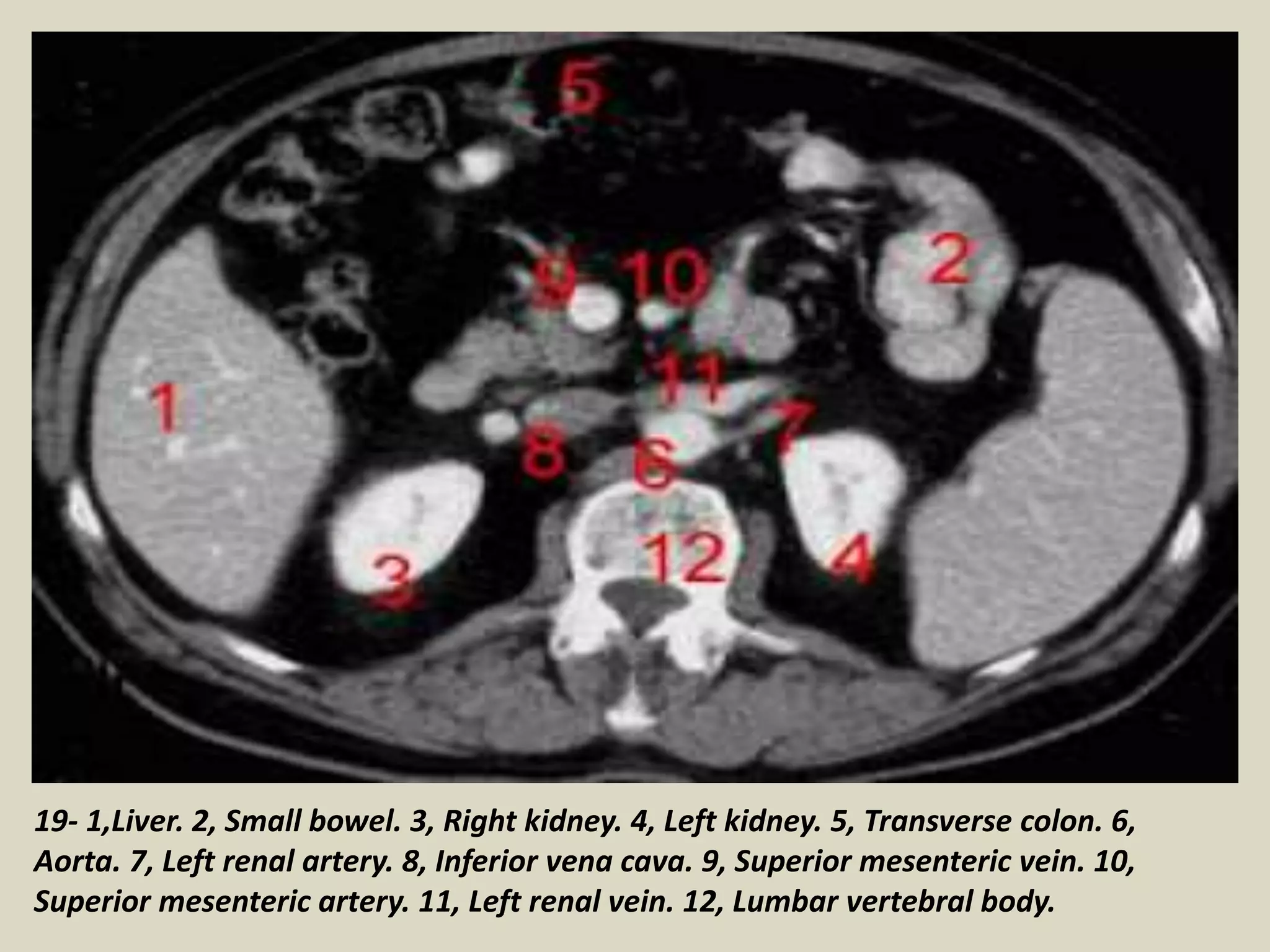 Presentation1.pptx, ct normal anatomy of the abdomen and pelvis. | PPTX