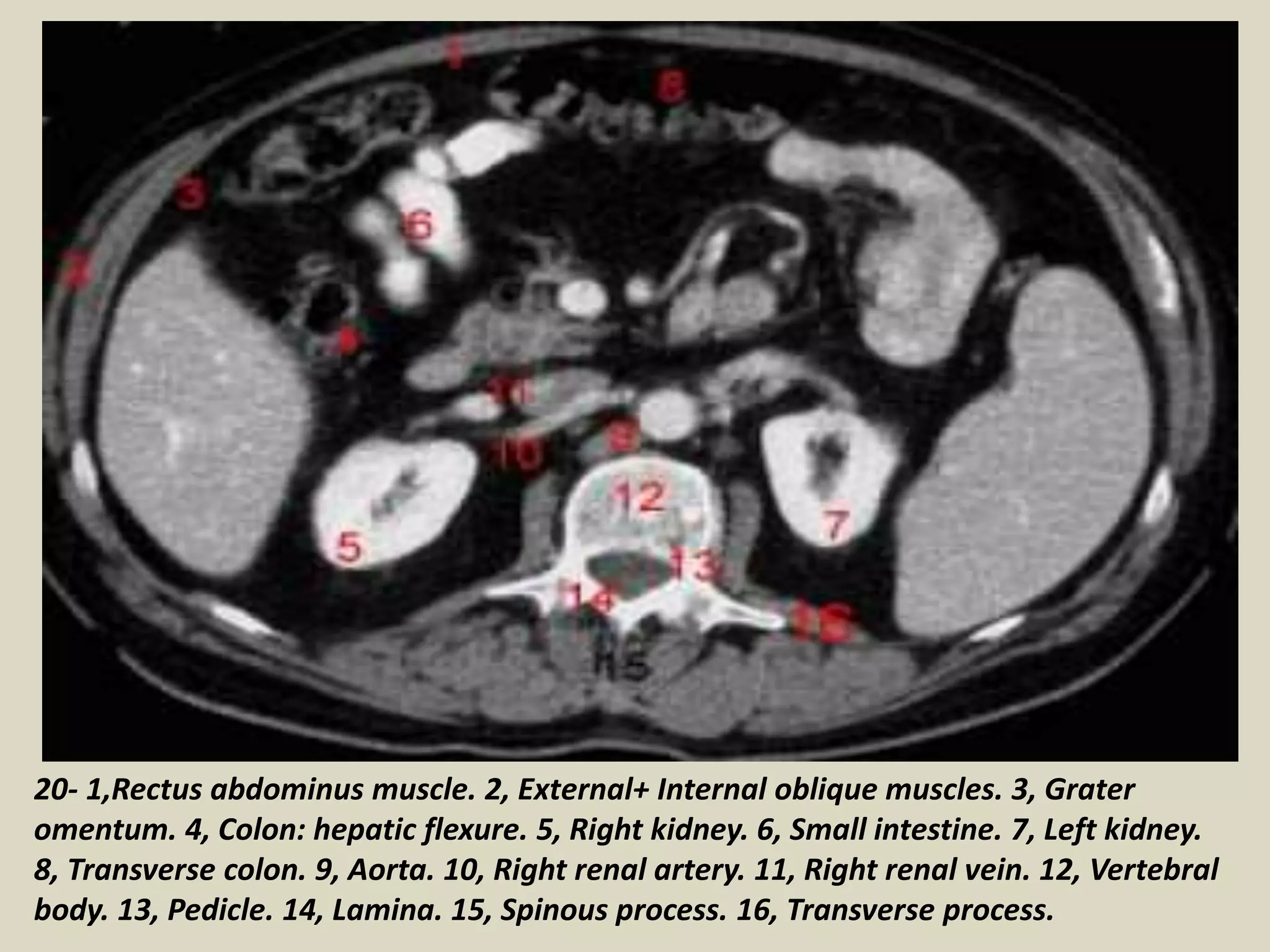 Presentation1.pptx, ct normal anatomy of the abdomen and pelvis. | PPTX