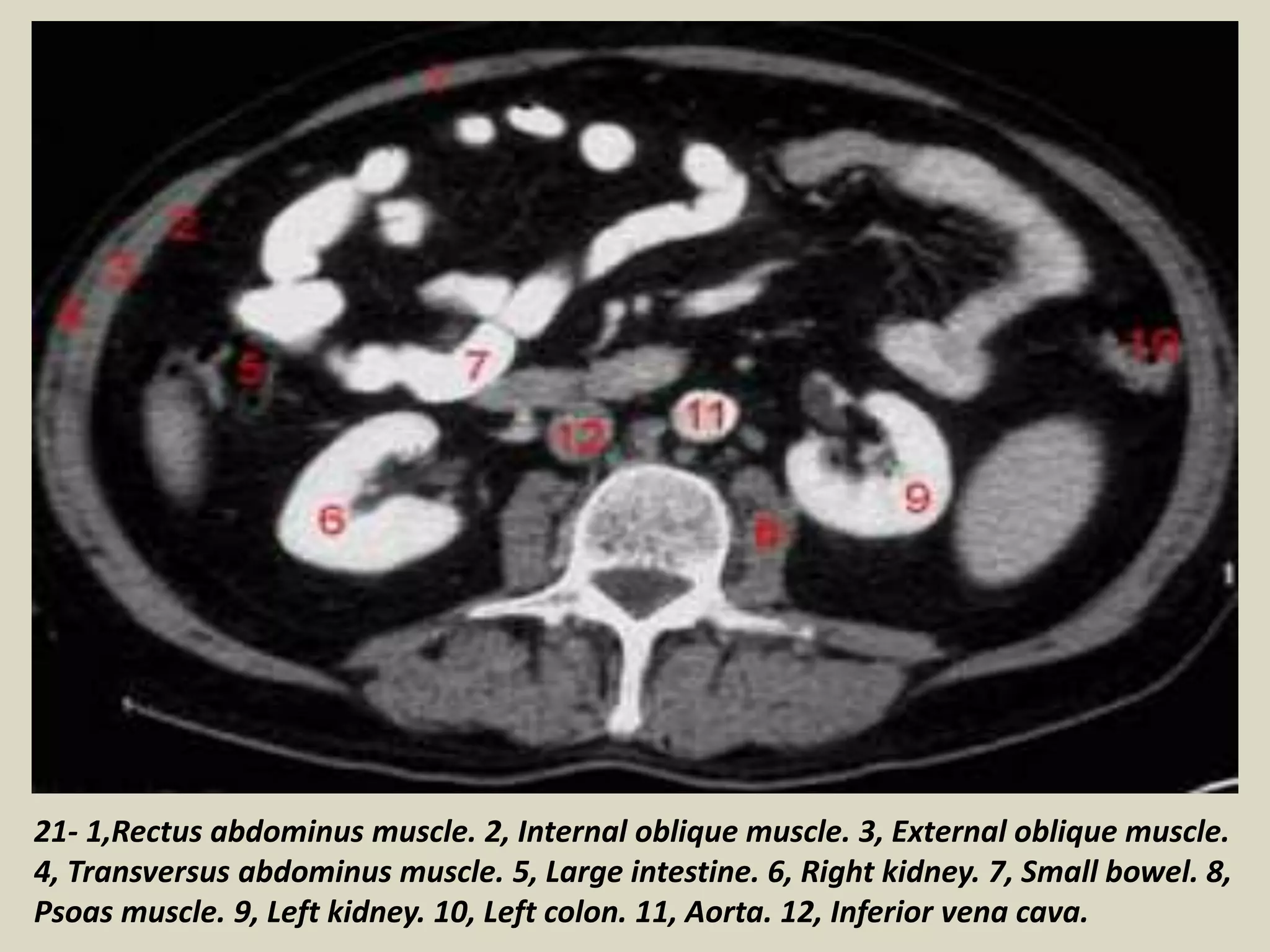 Presentation1.pptx, ct normal anatomy of the abdomen and pelvis. | PPTX