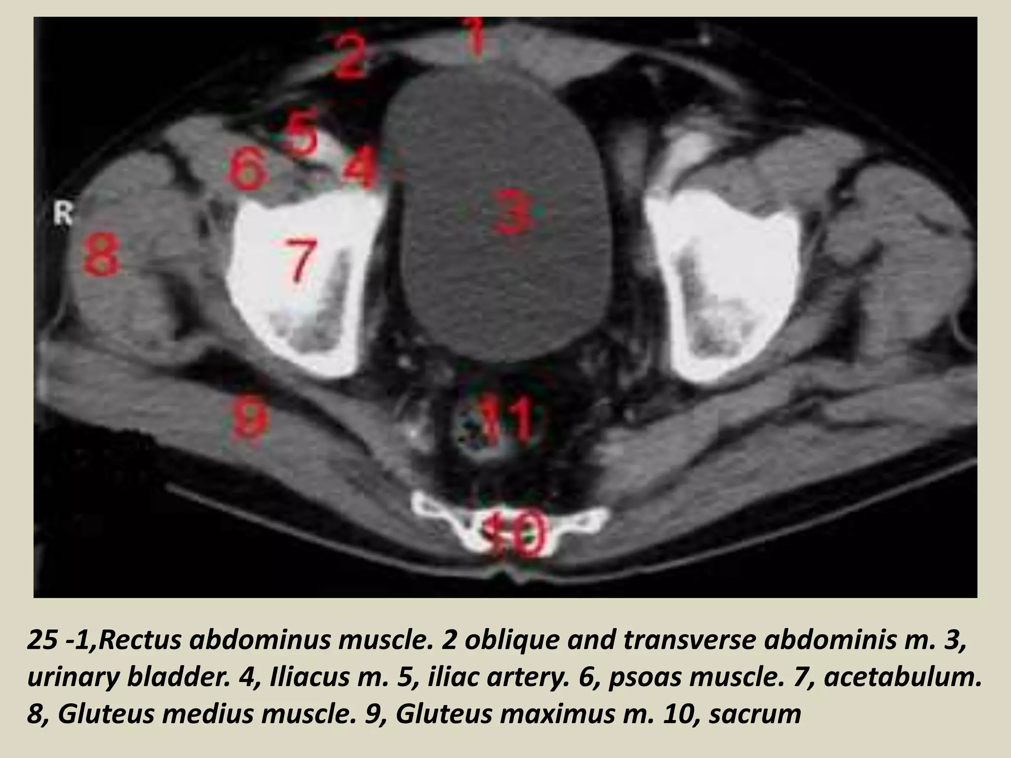 Presentation1.pptx, ct normal anatomy of the abdomen and pelvis. | PPTX