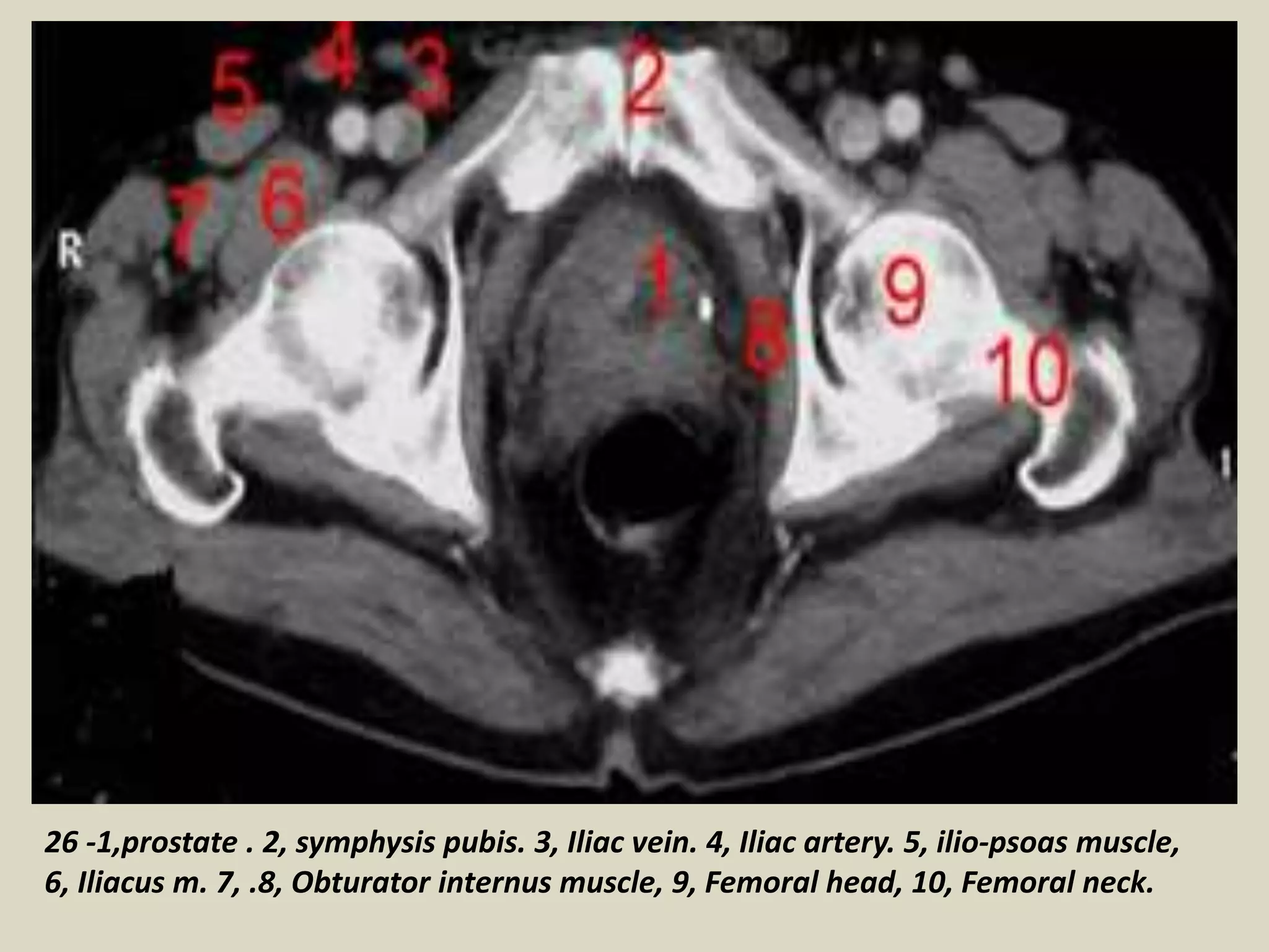 Presentation1.pptx, ct normal anatomy of the abdomen and pelvis. | PPTX