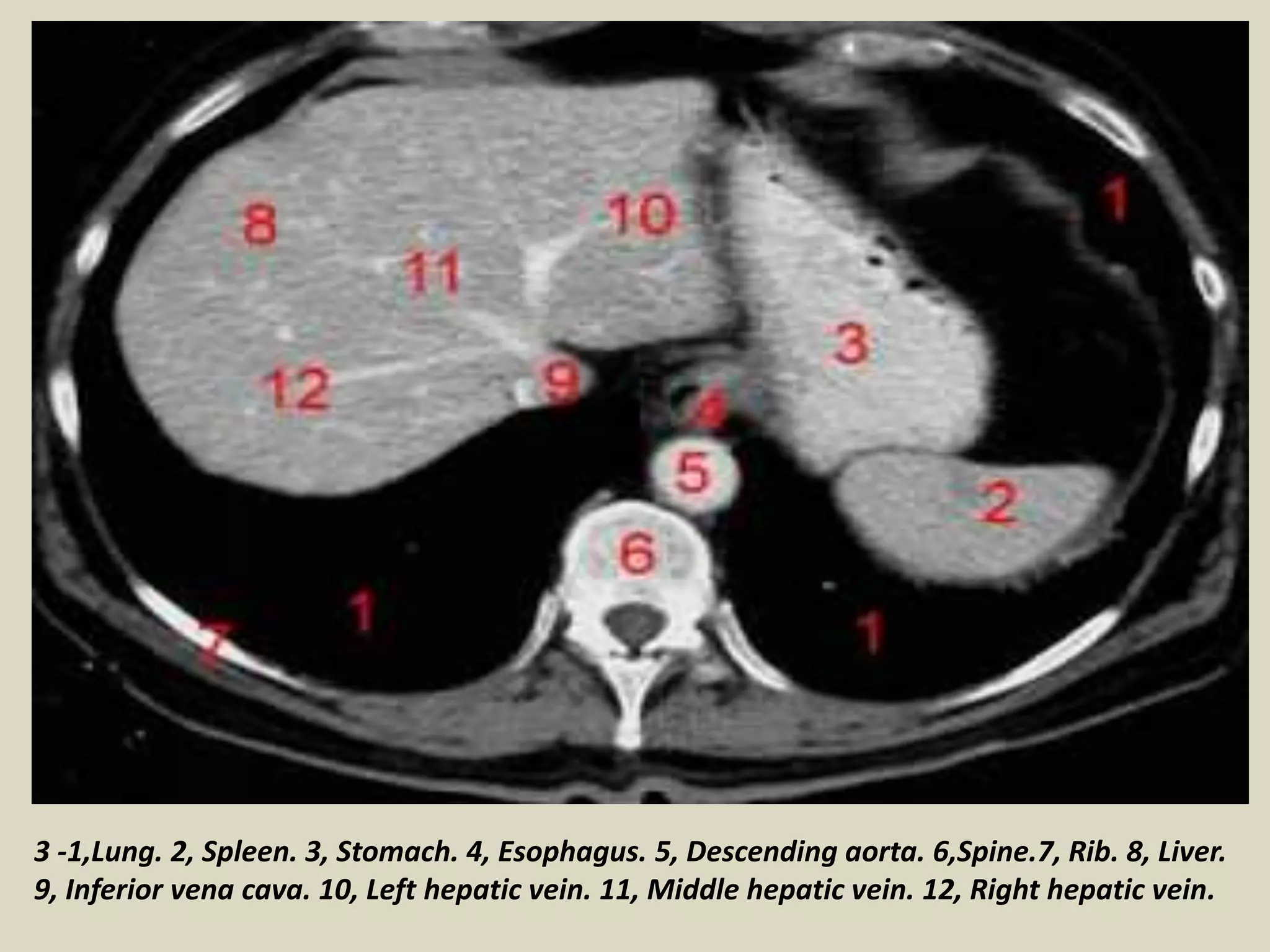 Presentation1.pptx, ct normal anatomy of the abdomen and pelvis. | PPTX