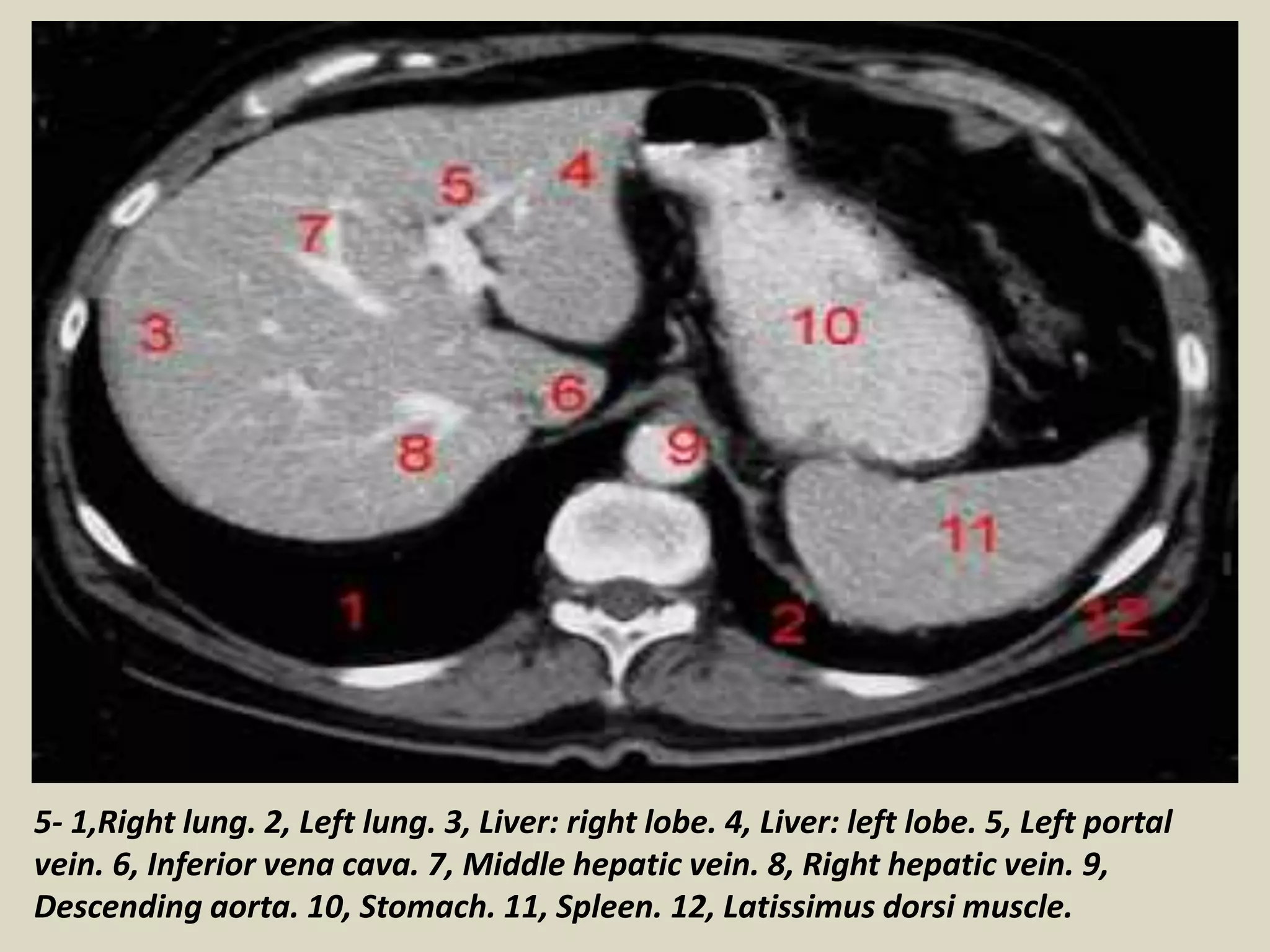 Presentation1.pptx, ct normal anatomy of the abdomen and pelvis. | PPTX
