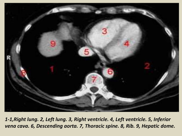 Presentation1.pptx, ct normal anatomy of the abdomen and pelvis. | PPTX ...