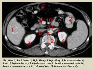 Presentation1.pptx, ct normal anatomy of the abdomen and pelvis. | PPTX