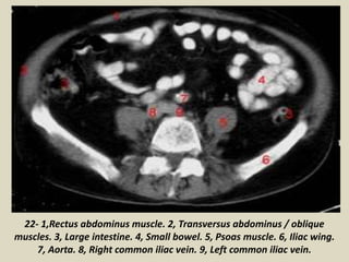 Presentation1.pptx, ct normal anatomy of the abdomen and pelvis. | PPTX