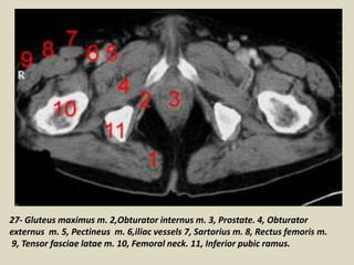 Presentation1.pptx, ct normal anatomy of the abdomen and pelvis. | PPTX